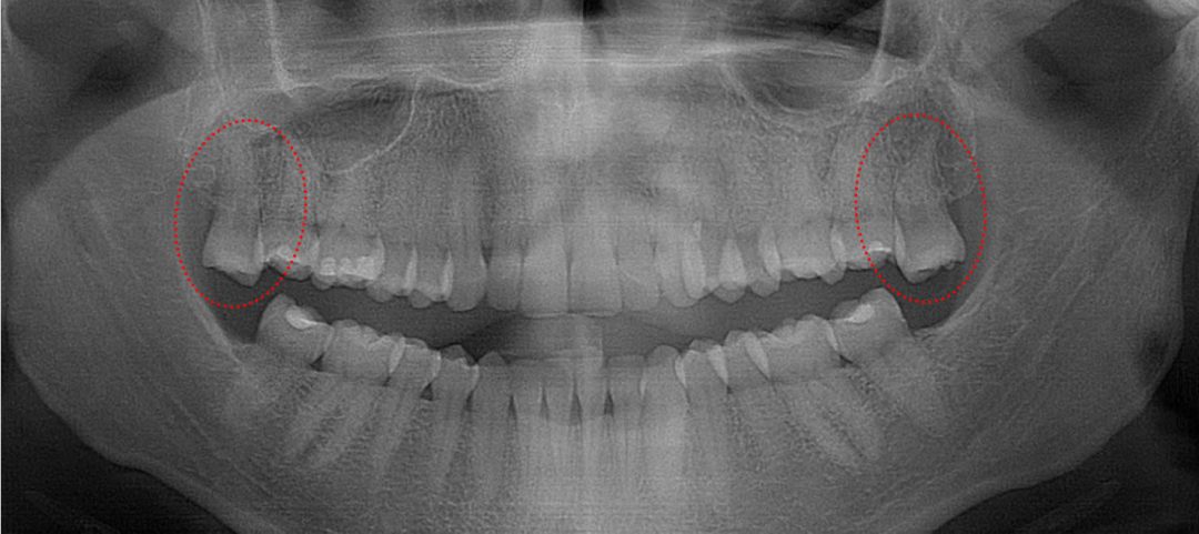 Wisdom Teeth Development - TriAgenics, Inc