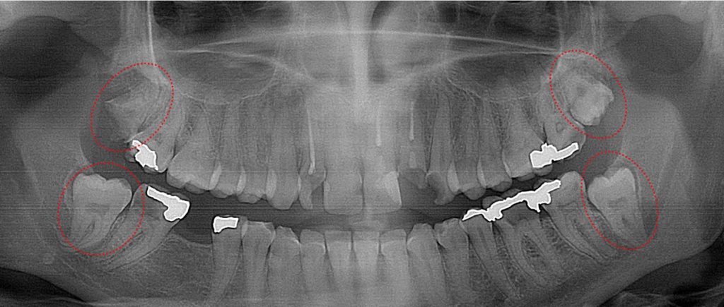 Wisdom Teeth Pathology - TriAgenics, Inc