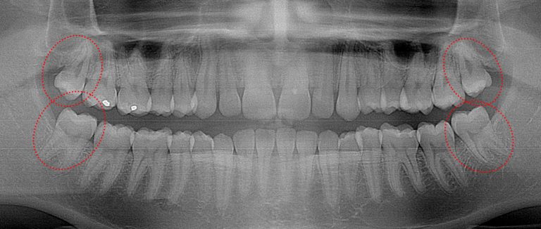 Wisdom Teeth Development - TriAgenics, Inc