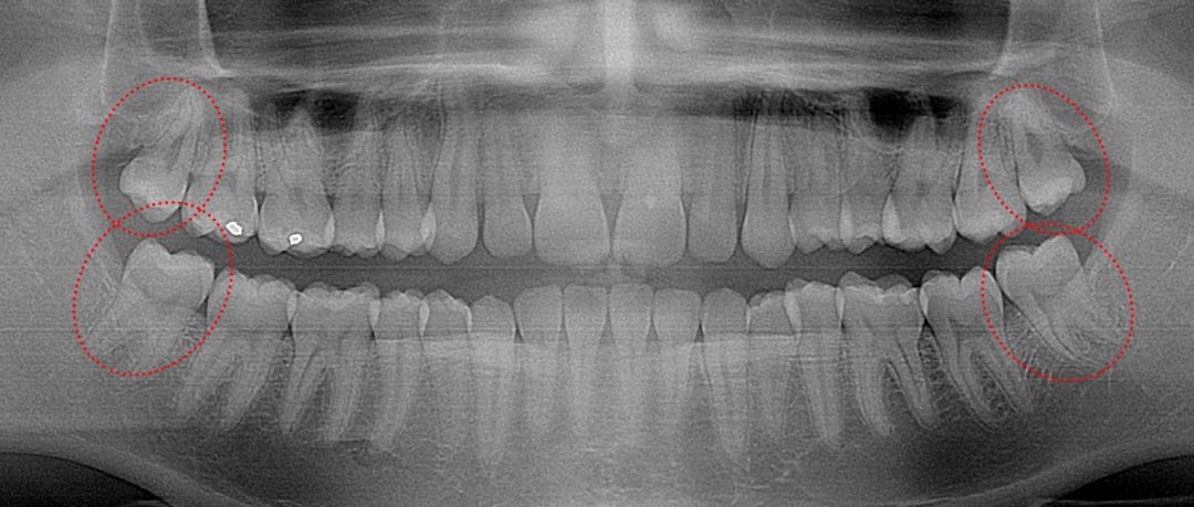 Wisdom Teeth Pathology - TriAgenics, Inc