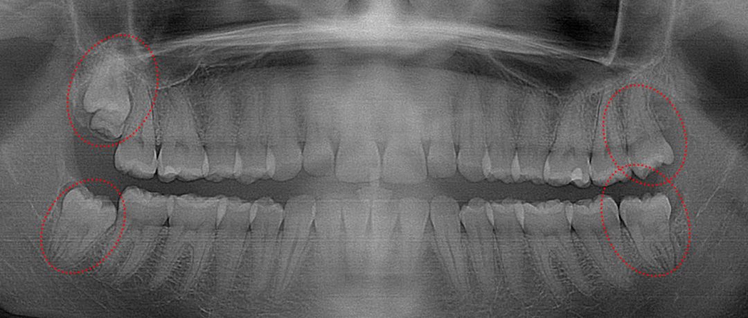 Wisdom Teeth Development - TriAgenics, Inc
