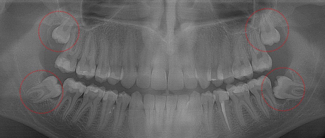 Wisdom Teeth Development - TriAgenics, Inc