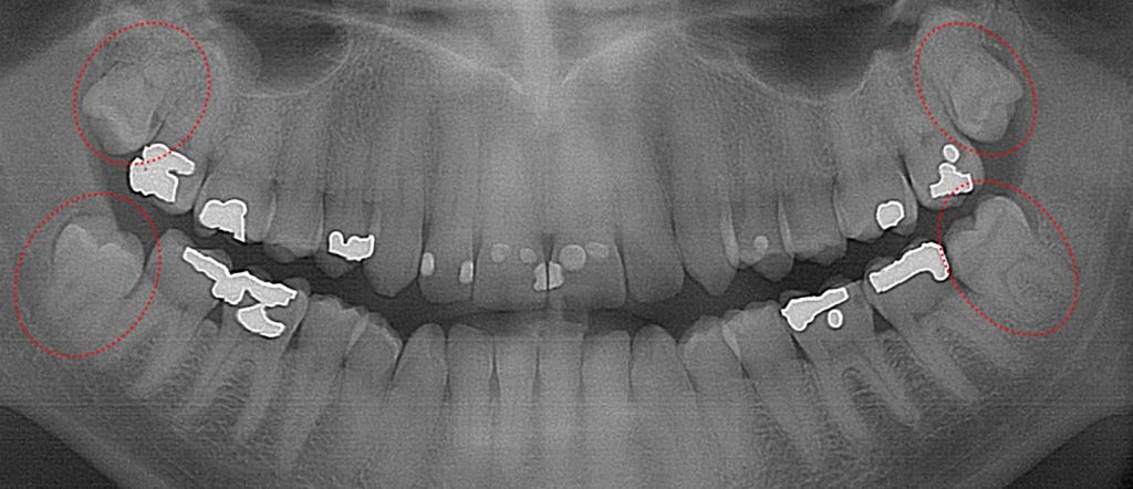 Wisdom Teeth Development - TriAgenics, Inc