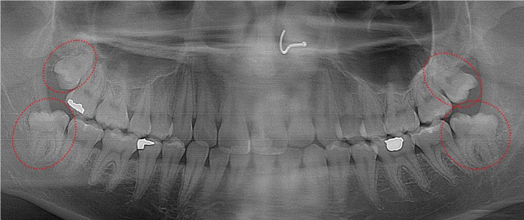Wisdom Teeth Development - TriAgenics, Inc