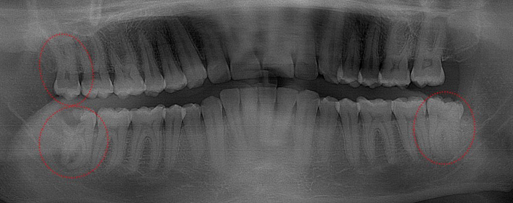 Wisdom Teeth Development - TriAgenics, Inc