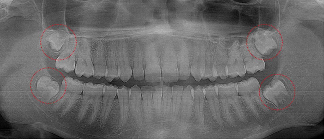 Wisdom Teeth Development - TriAgenics, Inc