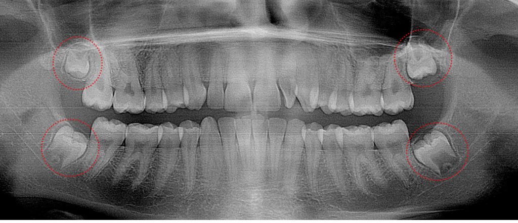 Wisdom Teeth Development - TriAgenics, Inc