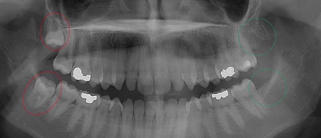 Wisdom Teeth Development - TriAgenics, Inc