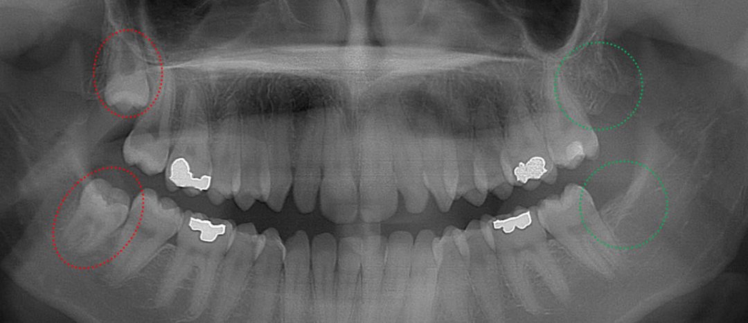 Wisdom Teeth Development - TriAgenics, Inc