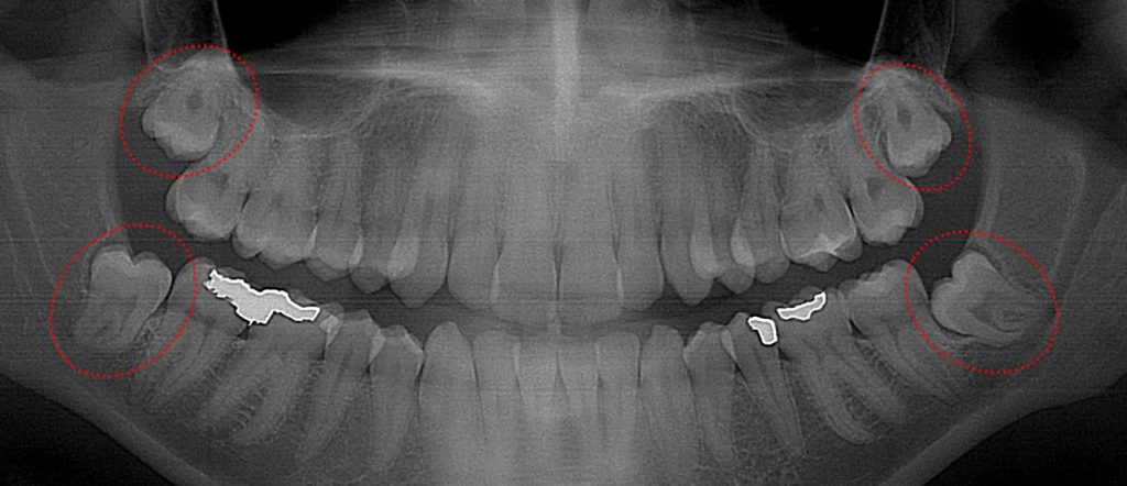 Wisdom Teeth Development - TriAgenics, Inc