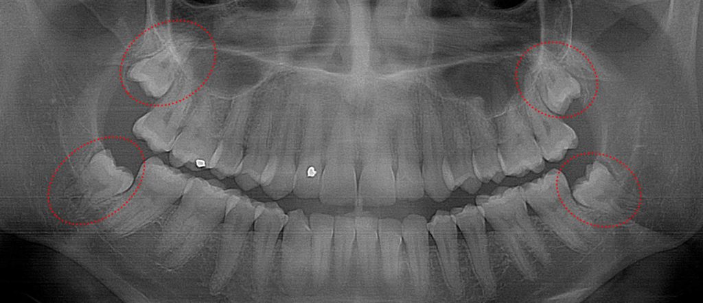 Wisdom Teeth Development - TriAgenics, Inc