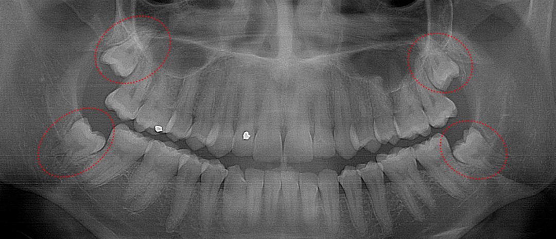 Wisdom Teeth Development - TriAgenics, Inc