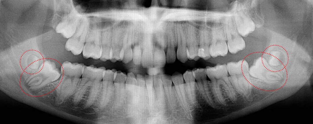 Wisdom Teeth Development - TriAgenics, Inc