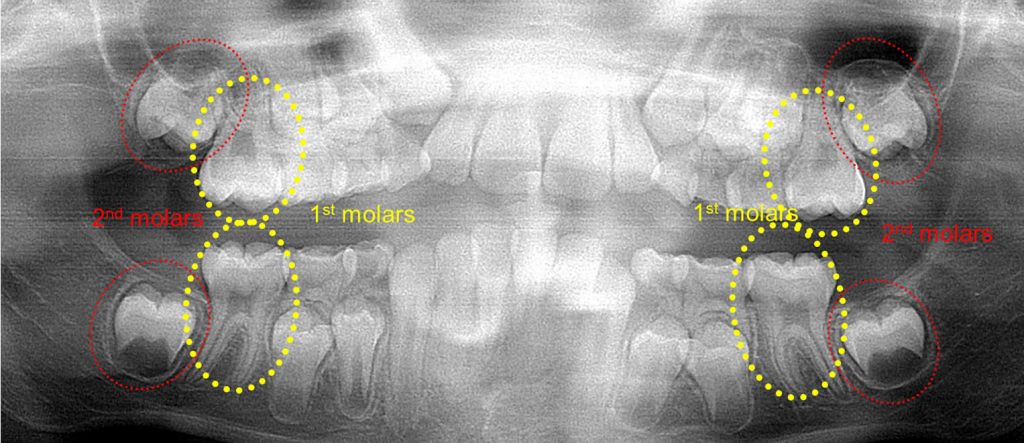 Wisdom Teeth Development - TriAgenics, Inc