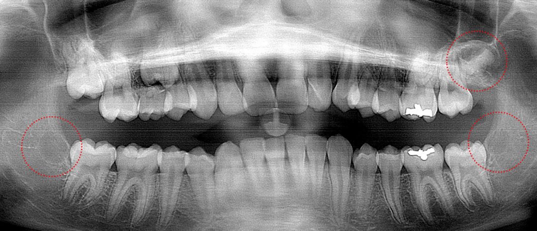 Wisdom Teeth Development - TriAgenics, Inc