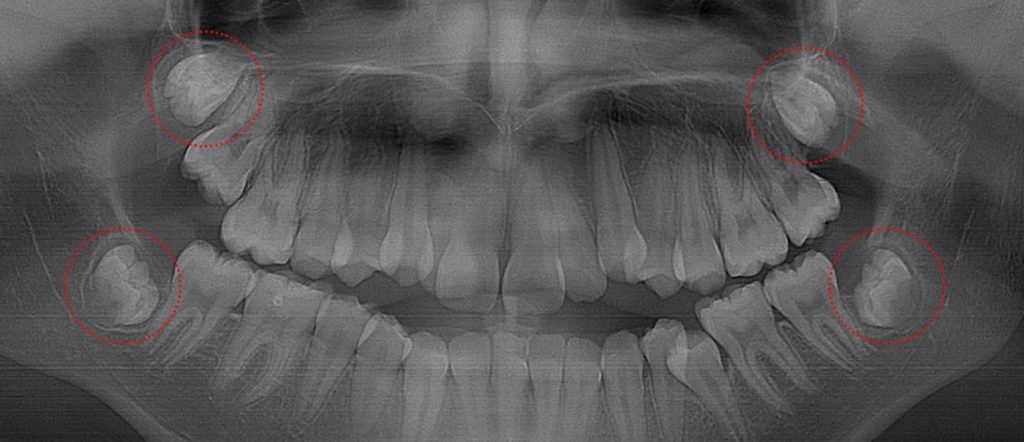 Wisdom Teeth Development - TriAgenics, Inc