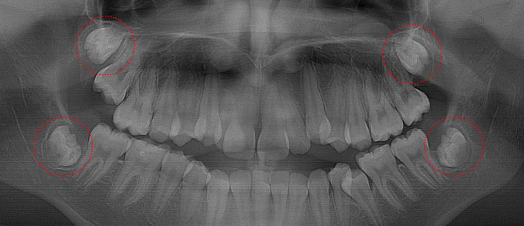 Wisdom Teeth Development - TriAgenics, Inc