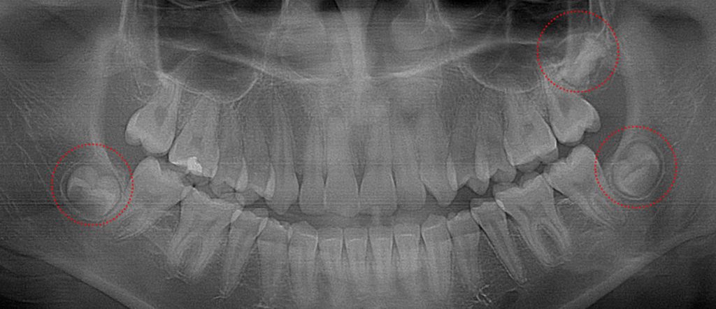 Wisdom Teeth Development - TriAgenics, Inc