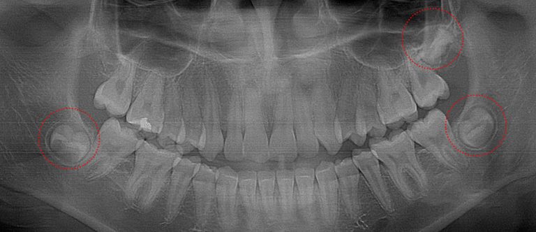 Wisdom Teeth Development - TriAgenics, Inc