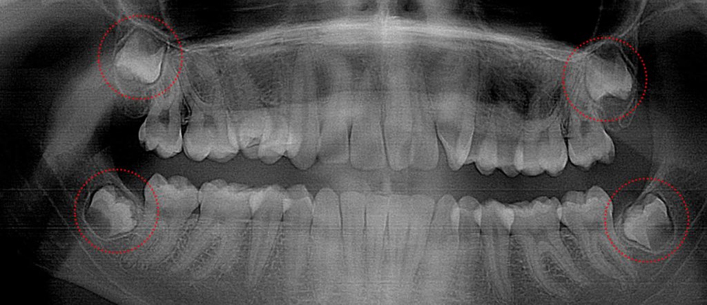 Wisdom Teeth Development - TriAgenics, Inc