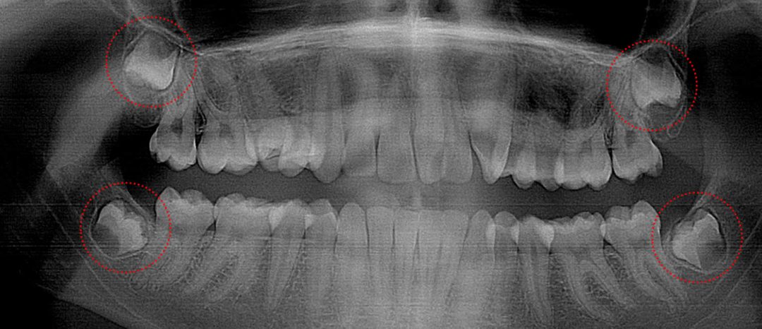 Wisdom Teeth Development - TriAgenics, Inc